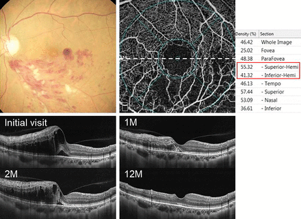 Macular vessel reduction as predictor for recurrence of macular oedema ...