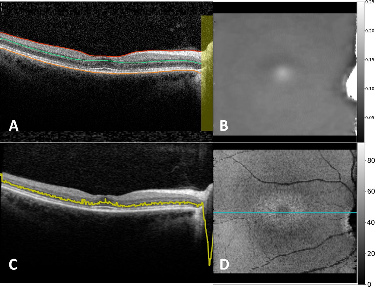 Quantitative analysis of optical coherence tomography imaging in ...