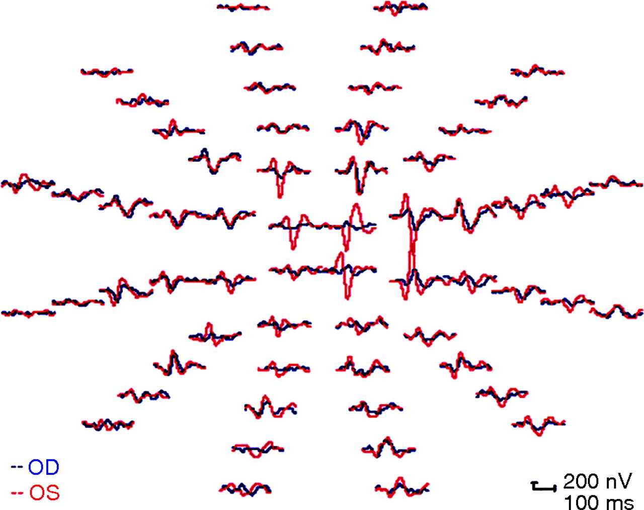 Multifocal visual-evoked potential in unilateral compressive optic ...